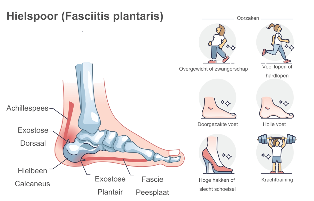 Fasciitis plantaris (hielspoor) aan uw voeten laten behandelen