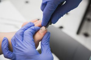 Verminder pijn door ingegroeide nagels met een nagelbeugel